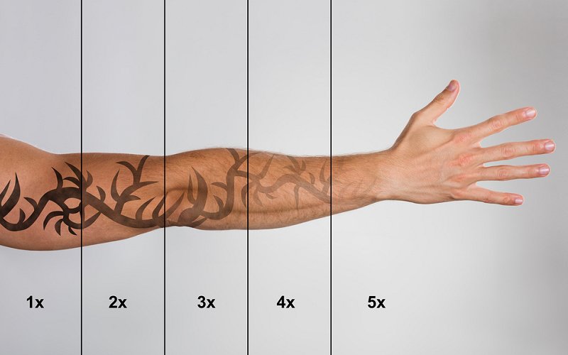 Preparation Strategies For Laser Tattoo Removal TIME BUSINESS NEWS